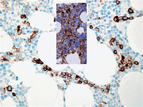 27 Bone Marrow Infiltration By T Large Granular Lymphocytic T Lgl Download Scientific Diagram