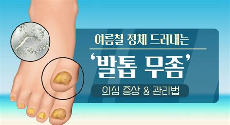 발톱무좀 증상 치료제 자가 치료 없애는 방법 자연치유 완전 정리 만수무강