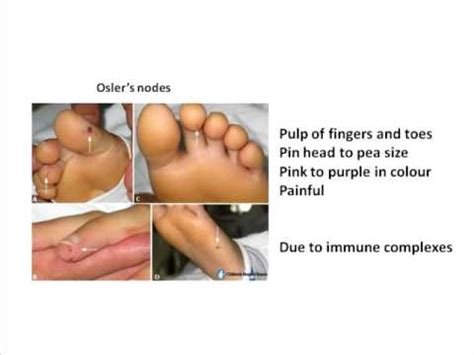 Osler Nodes Endocarditis