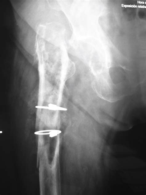 Quality Of Life After Girdlestone Resection Arthroplasty Revista Española De Cirugía