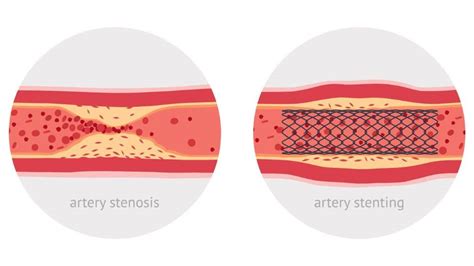 Stenosis Imaging And Interventional Specialists