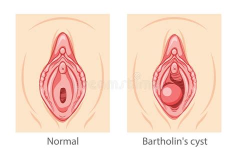 Bartholin S Cyst Gland Female Reproductive System Uterus Female Sick