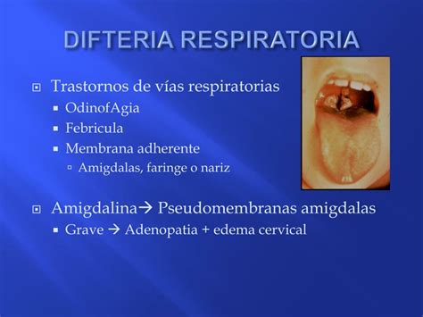 Ppt Tosferina Sx Coqueluchoide Difteria Powerpoint Presentation Free