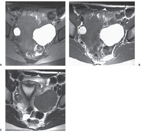 141 Mature Cystic Teratoma Dermoid Cyst Radiology Key
