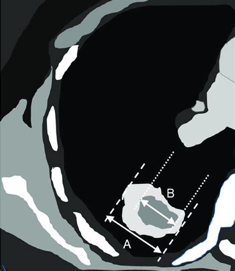 Definition Of Consolidation Tumor Ratio Ba A Maximal Diameter Of Download Scientific