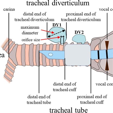 the scheme of simulated positional relationships between tracheal