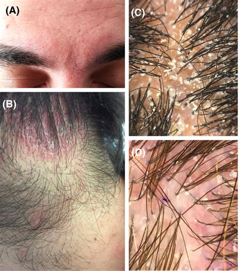 Pityrosporum Folliculitis Scalp