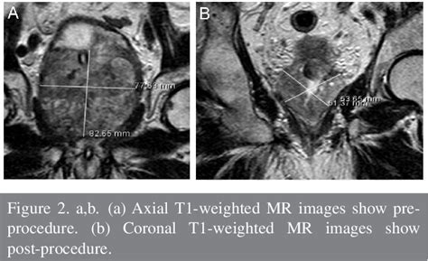 Figure 2 From Clinical Outcomes Of Prostatic Artery Embolization In Patients With Benign