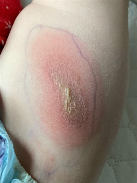 Bug Bite Cellulitis Rdermatologyquestions