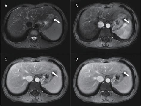 Figure 1 From Update On The Diagnosis And Treatment Of Combined Hepatocellular
