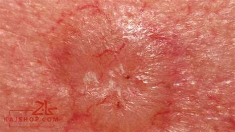 کدام لکه های پوستی خطرناکند؟ تصاویر انواع لکه های قرمز پوستی