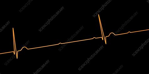 Complete Heart Block Electrocardiogram Illustration Stock Image F042 7684 Science Photo