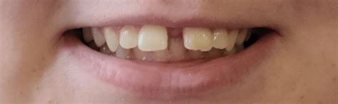 Braces Are Off R Braces