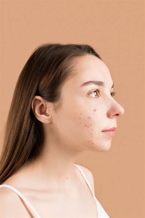 Acne Scars Pih And Pie Free Bunni