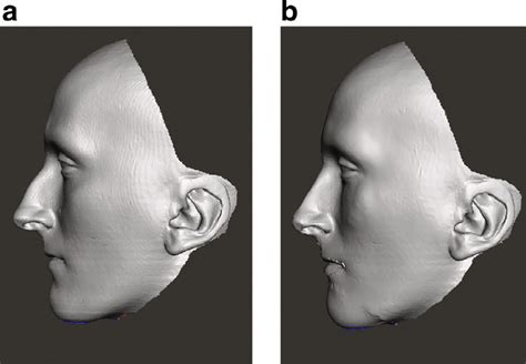 Preoperative Soft Tissue Rendering A Simulation Of Postoperative Download Scientific Diagram