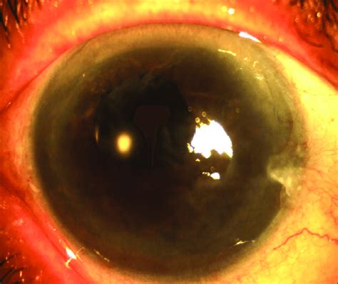 Pseudophakic Bullous Keratopathy Occurred 2 Years After Cataract Surgery Download Scientific