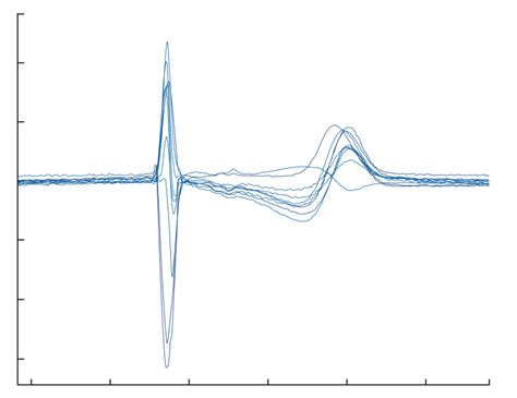 qt interval monitoring in periop and critical care clinical view
