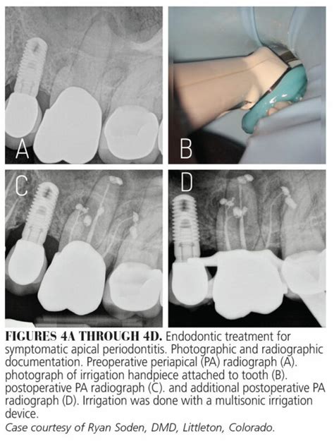 New Paradigms In Endodontic Irrigation Decisions In Dentistry