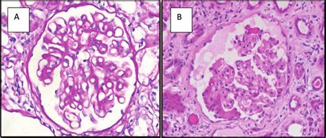 Normal Glomerulus Electron Microscopy