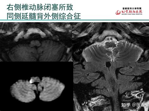 延髓背外侧综合征 知乎