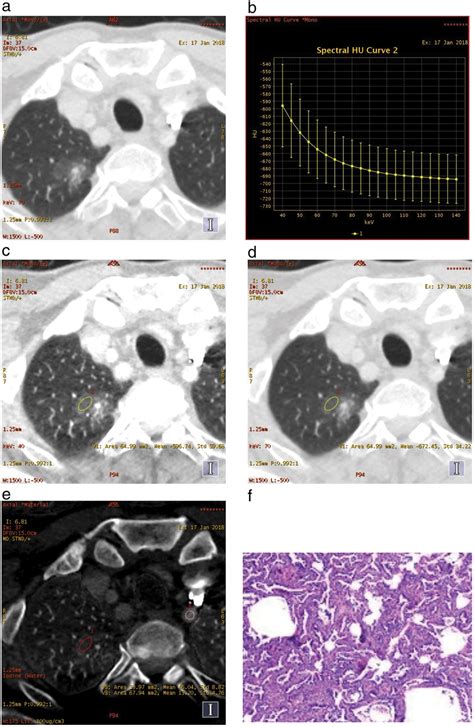 A Mixed Ground Glass Nodule In A The Right Upper Lobe B The Download Scientific Diagram