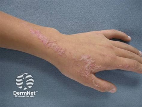 Epidermal Nevus Removal