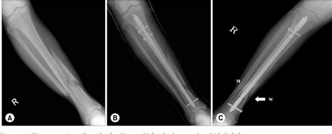 Figure 1 From Wedge Tibial Shaft Fractures Treated With Interlocking Im