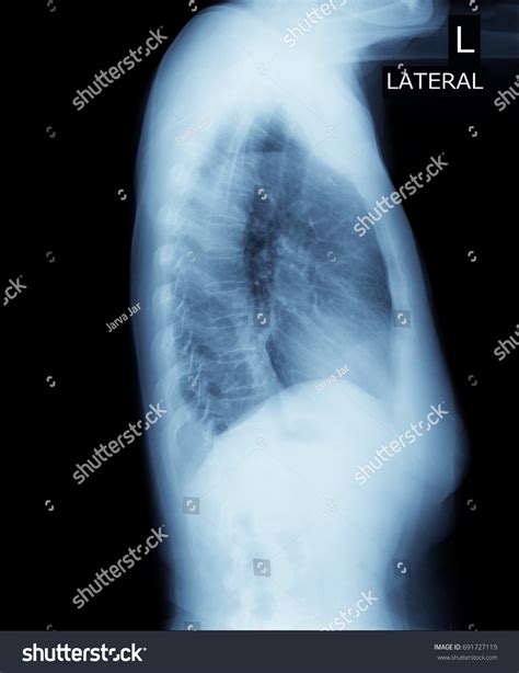 What Is A Decubitus Chest X Ray At Louise Oliva Blog