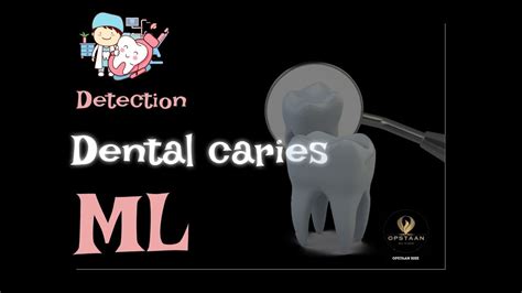 Ai Powered Dental Caries Detection System Machinelearning Project Finalyearprojects Major