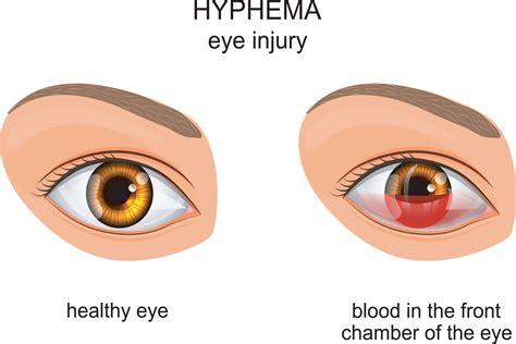 Hyphema Symptoms Causes Diagnosis And Treatment Accuspire