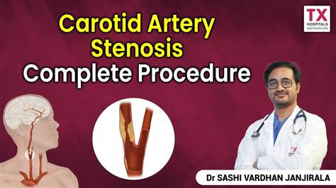 Carotid Artery Stenosis Procedure Explained By Dr Shasi Janjirala Tx Hospitals Youtube