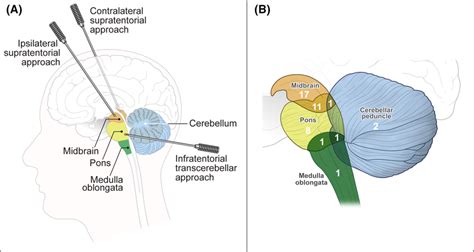 A Three Approaches To Stereotactic Biopsy For Brainstem Lesions B Download Scientific