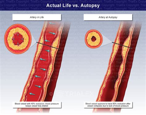 Actual Life Vs Autopsy Trial Exhibits Inc