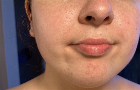 Routine Help Tips To Reduce Redness R SkincareAddiction