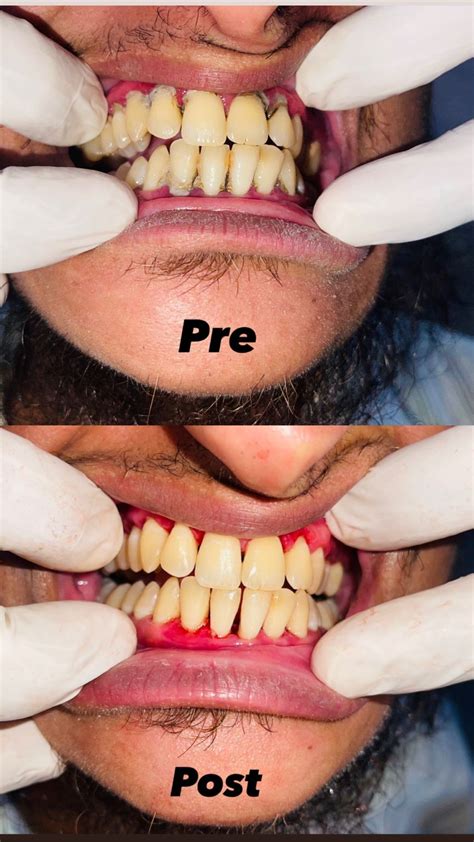 This Patient Complained Of Bleeding Gingiva Bad Breath And Food