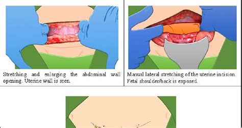 Figure 1 2 From Lower Segment Caesarean Section Evidence Based Practice Semantic Scholar