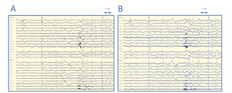 Interictal 23 Electrodes Eeg Recording Showing Spikes And Spikes Waves Download Scientific