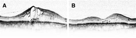 Hyperreflective Foci In Oct Image As A Biomarker Of Poor Prognosis In Diabetic Macular Edema
