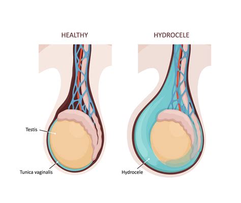 Understanding Hydrocele Diagnosis And Management Aurora Health Care