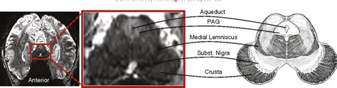 Figure 7 From Neuroimaging Of The Periaqueductal Gray State Of The