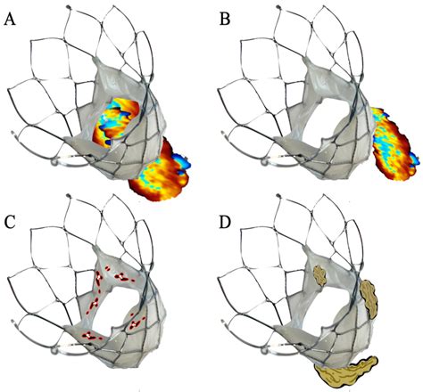 The Four Categories Of Bioprosthetic Valve Dysfunction A Structural Download Scientific