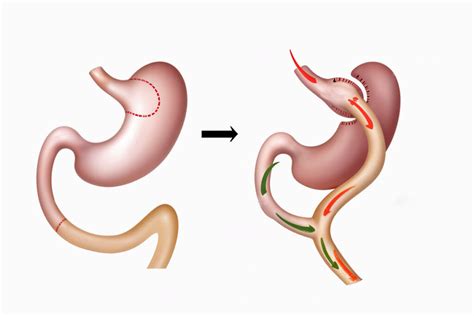 Roux En Y Gastric Bypass Anatomy Gastric Bypass Vs Sleeve