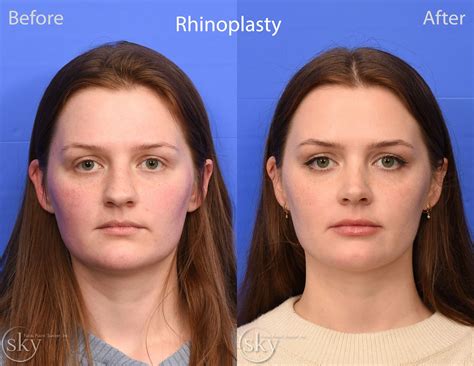 Rhinoplasty In Plastic Surgery Rhinoplasty Wonkaa