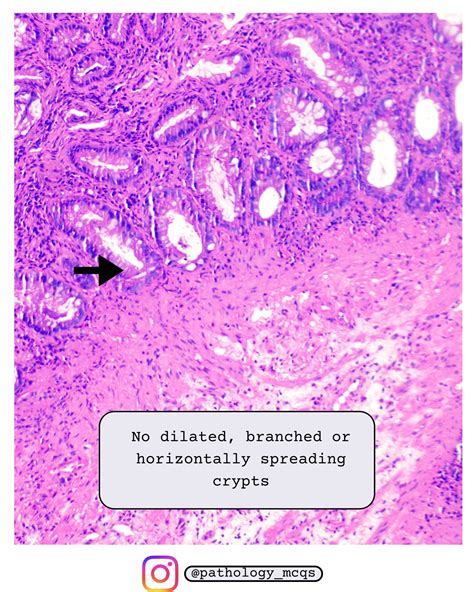 Hyperplastic Polyp Pathology Histology Diagnosis Mcqs And Differentiation