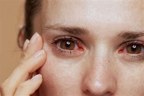 Dry Eyes Or Eye Allergies Know The Difference