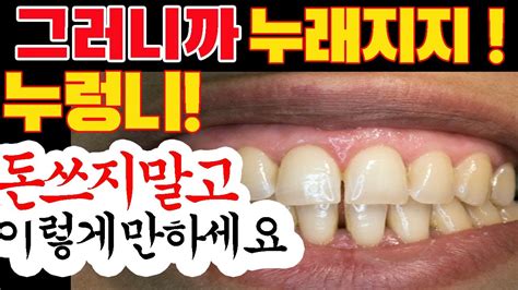 먹는즉시 이빨누래지는 7가지음식 Youtube