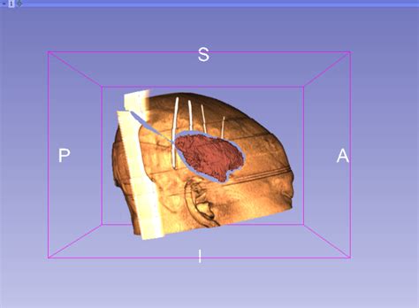 监测有道丨3d Slicer软件辅助神经内镜手术治疗基底节脑出血手术——颅脑创伤 神经重症周刊（第202期） 脑医汇