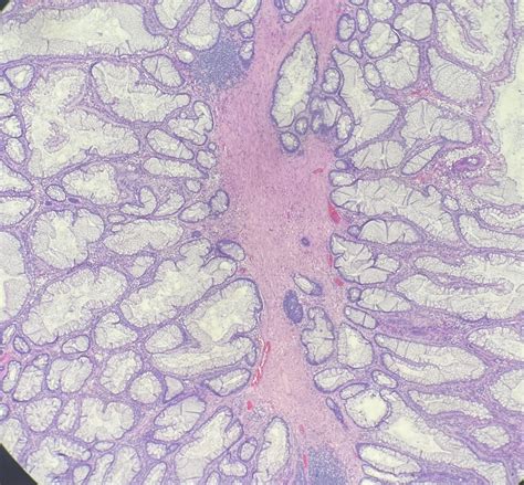 polyp classification live case see comments for details r pathology