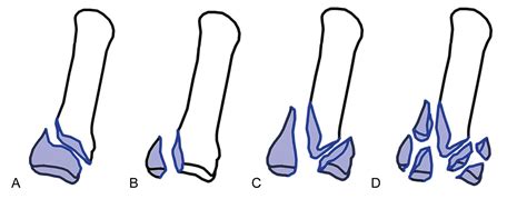 Orthoforum Fraktur Os Metacarpale