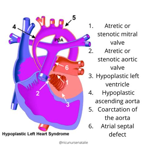 Hypoplastic Aorta